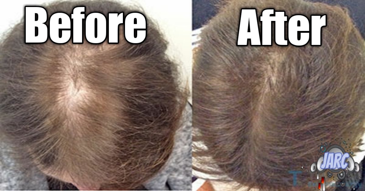 Hair loss causes and cure Know Today - Hair Advices